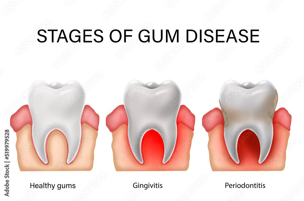 Collage with illustrations of healthy tooth with gum and infected ones ...