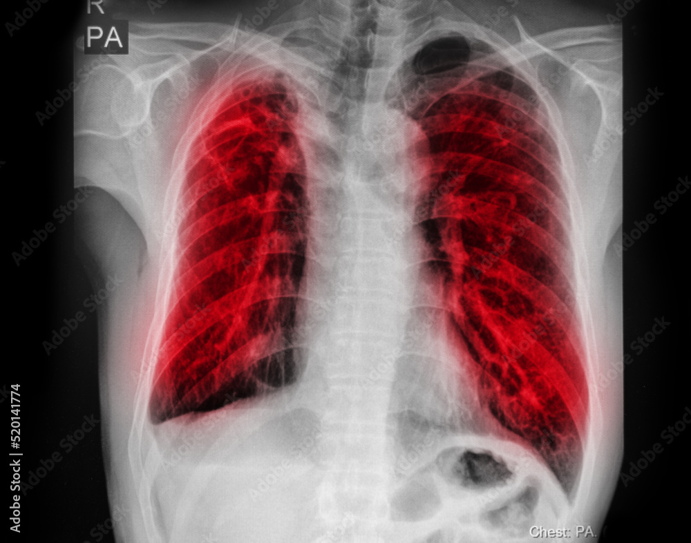 Pulmonary Tuberculosis ( TB ) : Chest x-ray show alveolar infiltration ...
