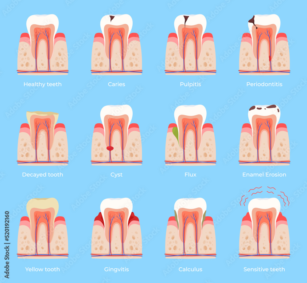 Different types of dental disease. Treatment of the oral cavity ...