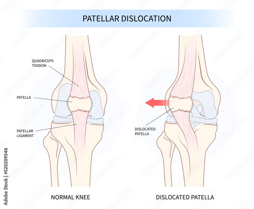 Knee bone patellar dislocated and subluxation patella dysplasia Painful Joint Stock Vector ...