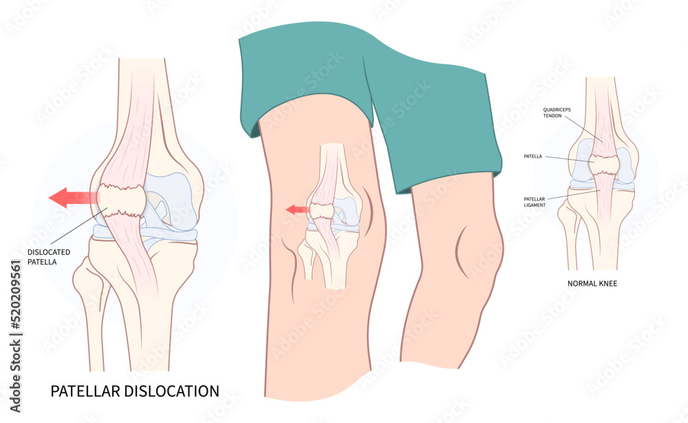 Knee injury and cause the patellar dislocated and subluxation patella ...