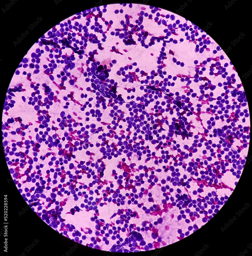 Cervical lymph node cytology: Lymphoproliferative disorder favor Non ...