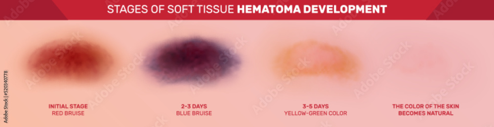 Hematoma Development Stages Set Stock Vector | Adobe Stock