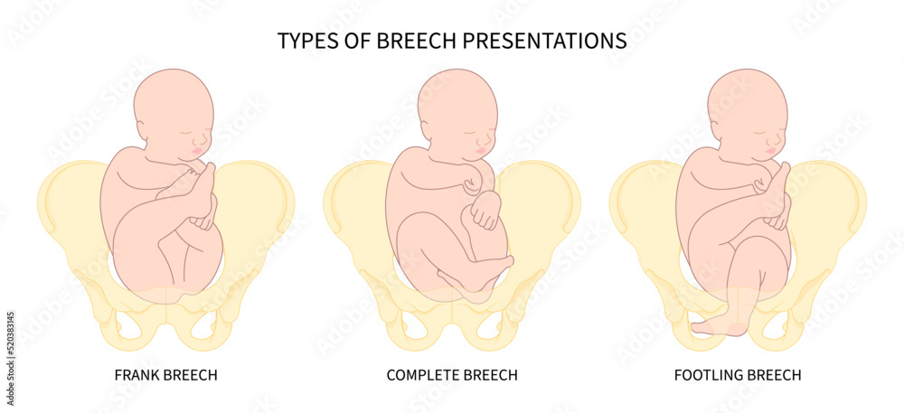 Stockvector Labor C section praevia Mother twins cord hip lie bone ...