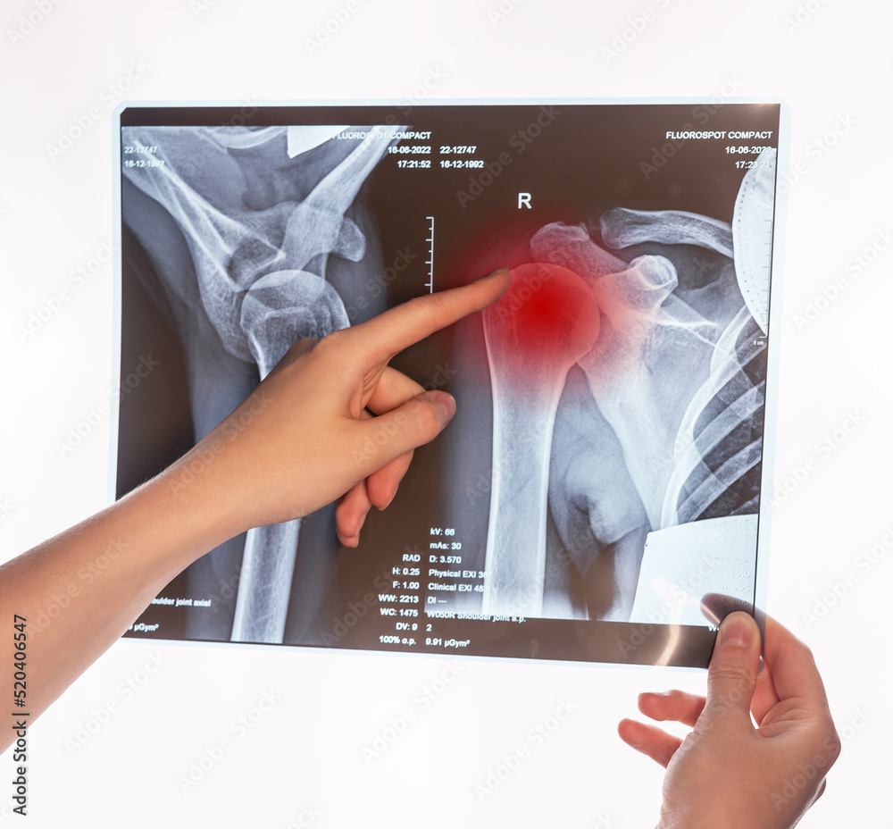 Forefinger pointing to trauma at arm X-ray image with red point ...