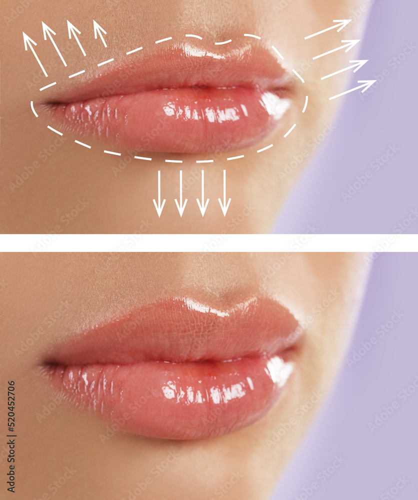 Collage with photos of young woman before and after lips augmentation ...