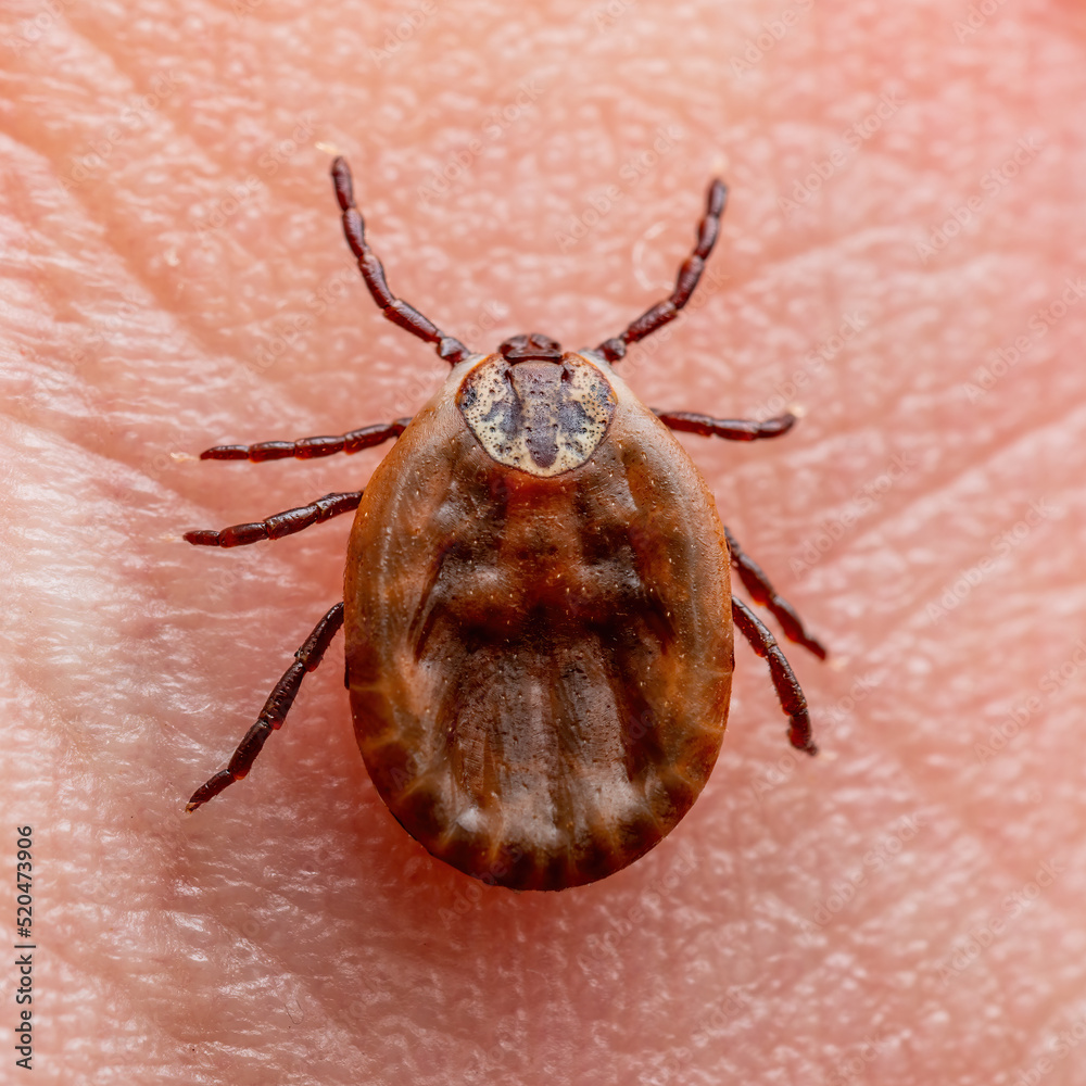 Infectious Encephalitis Tick Insect on Skin. Encephalitis Virus or Lyme ...