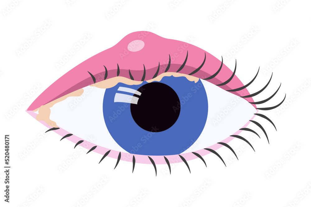 Human eye with swelled eyelid. Blepharitis. Eyeball inflammation ...