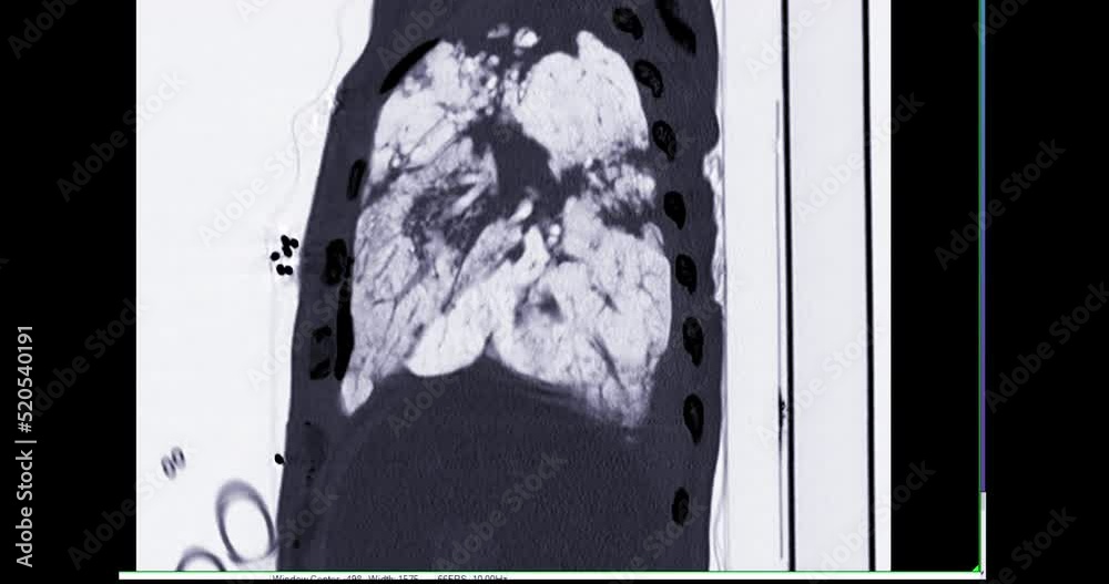 CT Chest or CT Scan of Lung axial MIP View for diagnosis TB,tuberculosis and coronavirus or ...