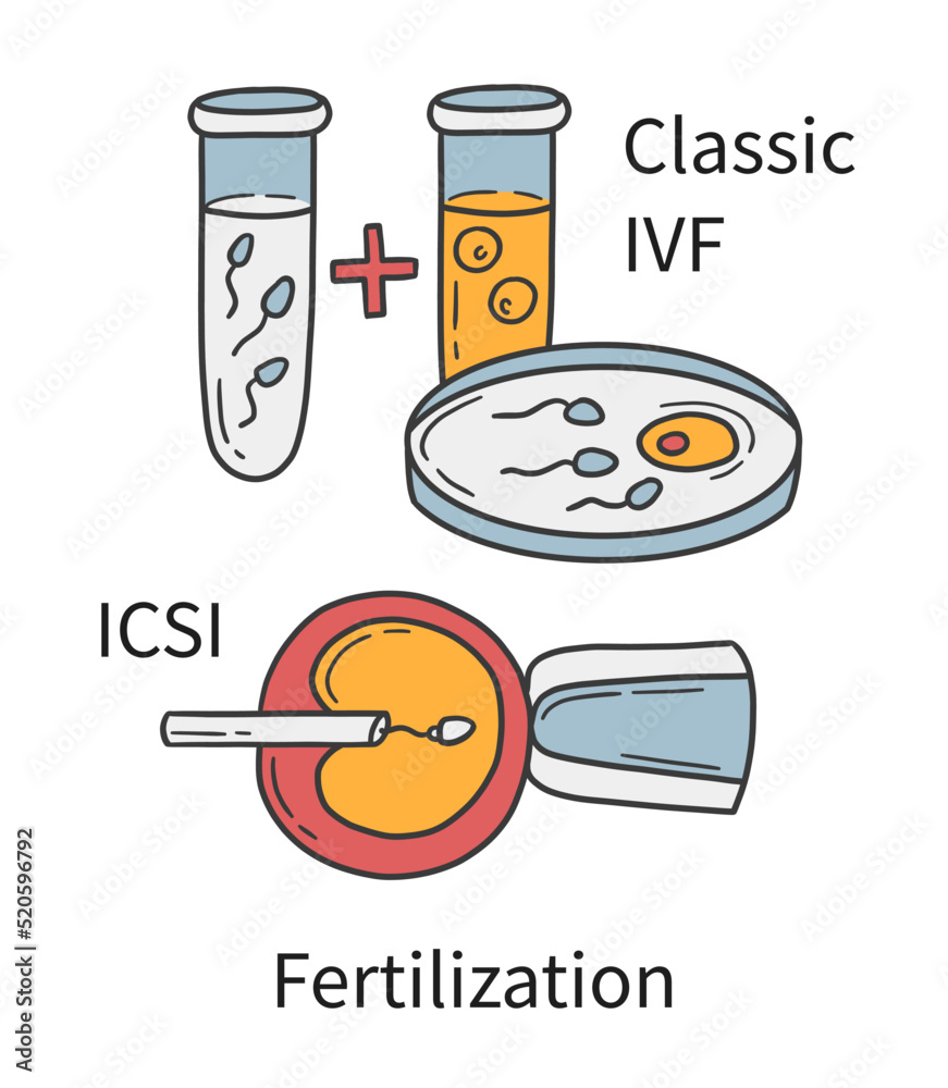 Vetor de In Vitro fertilization IVF of embryo and sperm in glass or ...