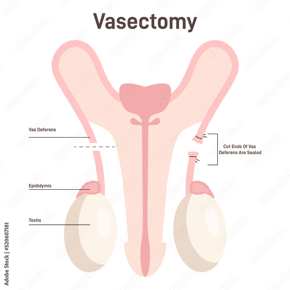 Vasectomy Surgical Procedure For Male Sterilization Male Reproductive Stock Vector Adobe Stock