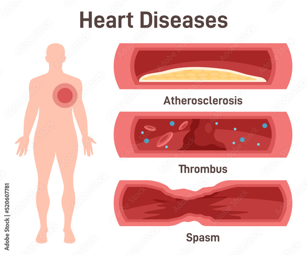 Heart disease set. Atherosclerosis, thrombus, coronary artery spasm ...