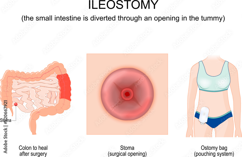 Ileostomy Stoma