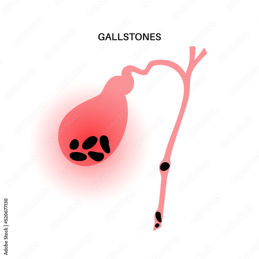 gallbladder stones anatomy Stock Vector | Adobe Stock