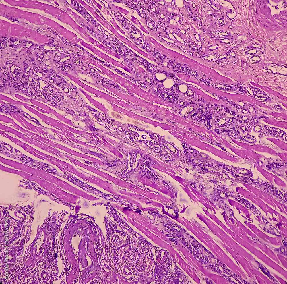 Vascular tumor of scalp biopsy: Intramuscular hemangioma, benign tumor ...