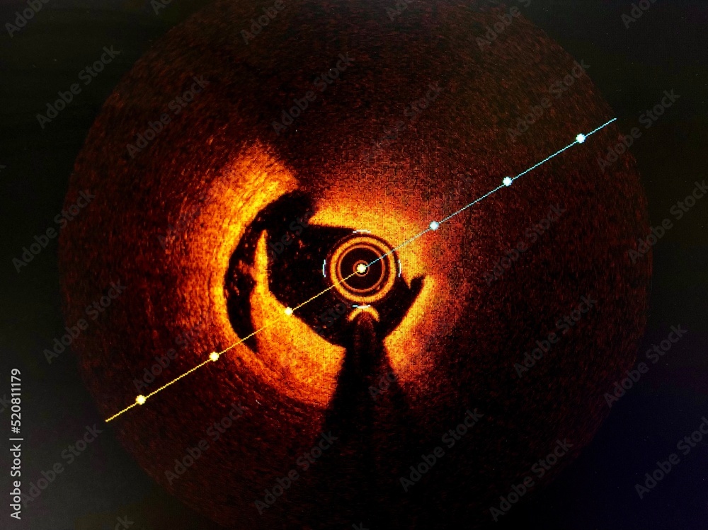 Intravascular imaging Optical Coherence Tomography (OCT) shown ...