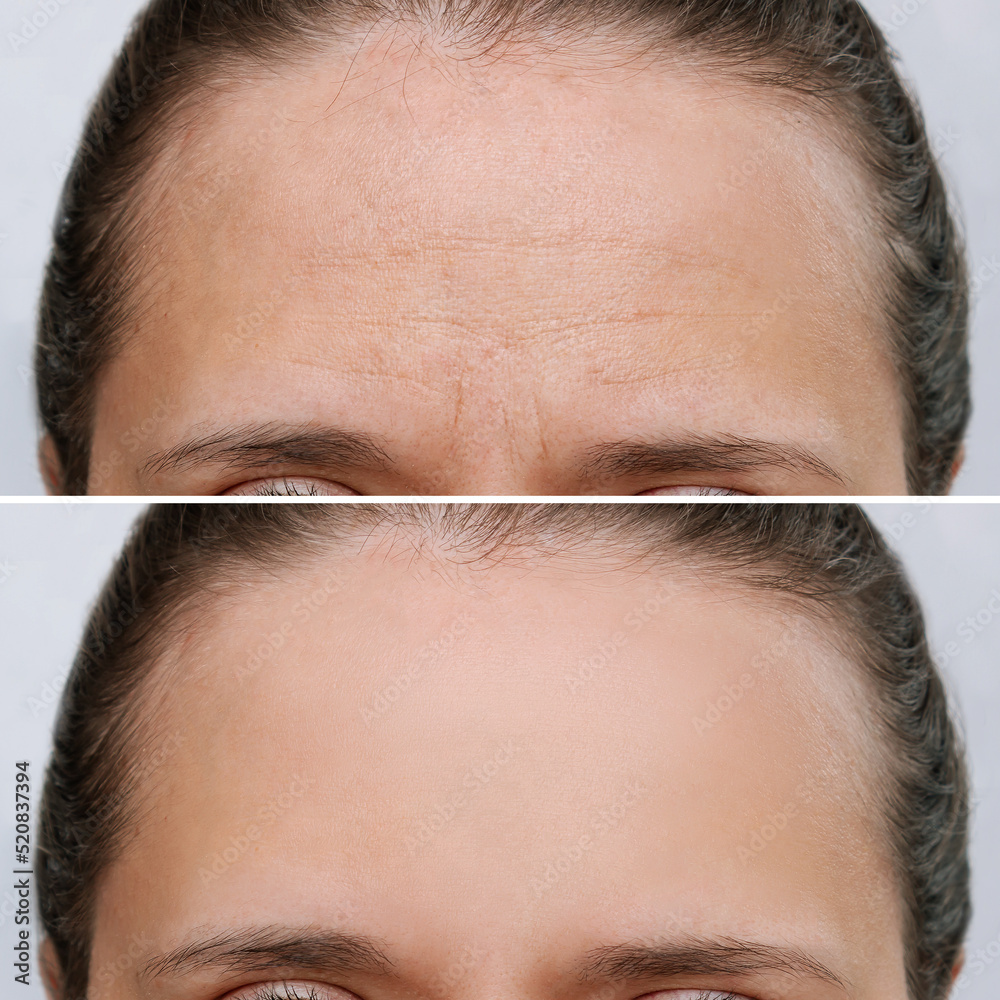 Young caucasian woman with wrinkles on the forehead before and after ...