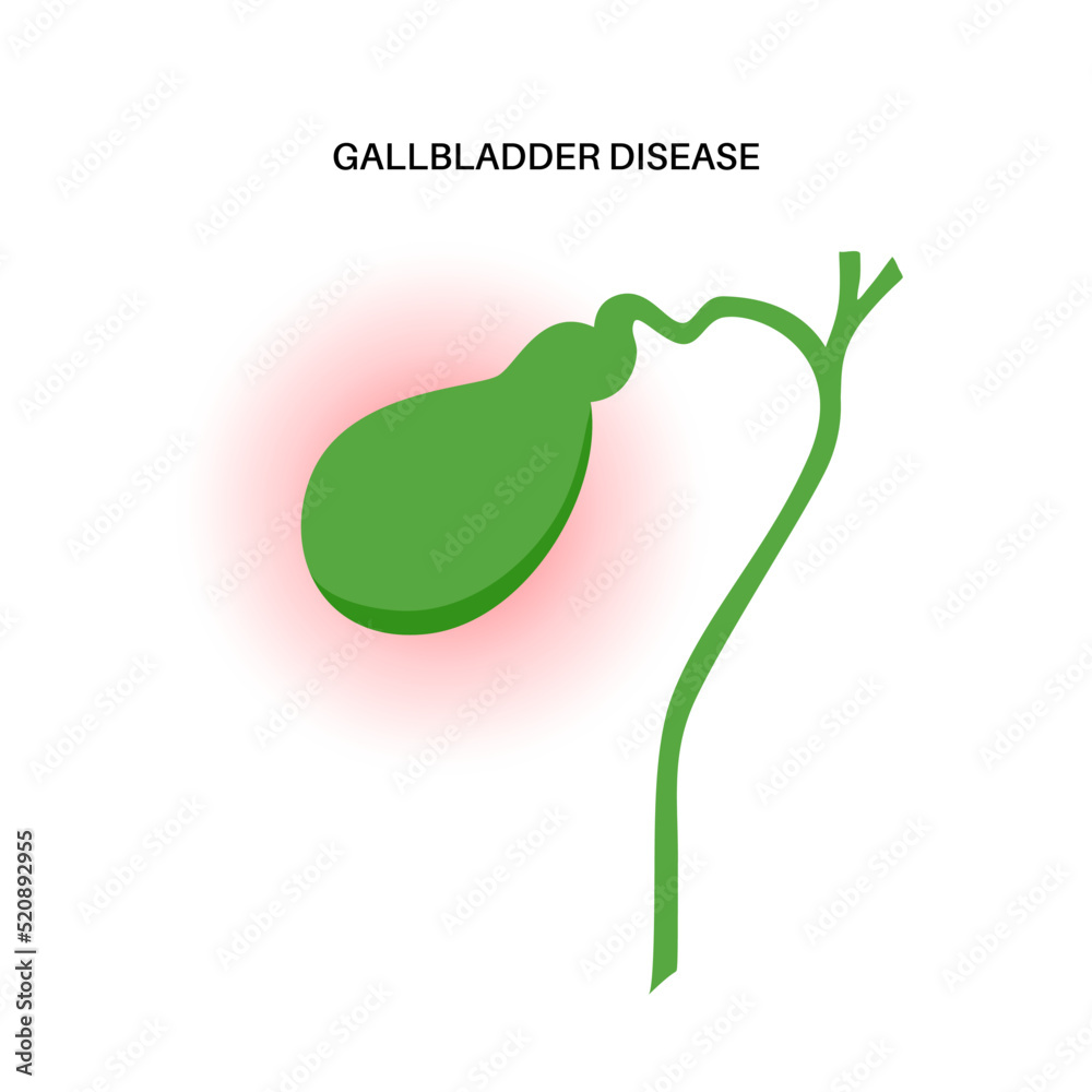 gallbladder disease poster Stock Vector | Adobe Stock