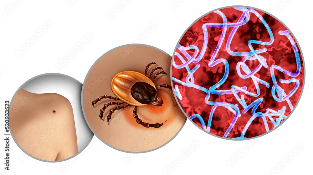 Lyme disease and Deer tick crawling on skin as a bacterial infection ...