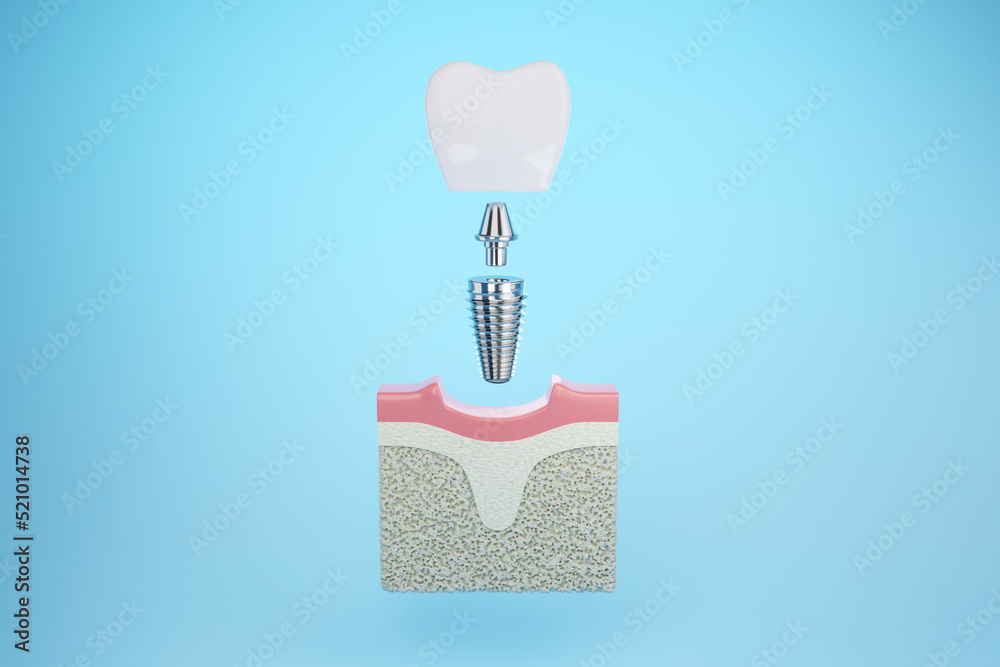 Layer of teeth implant and gums on blue background. Dental and teeth ...