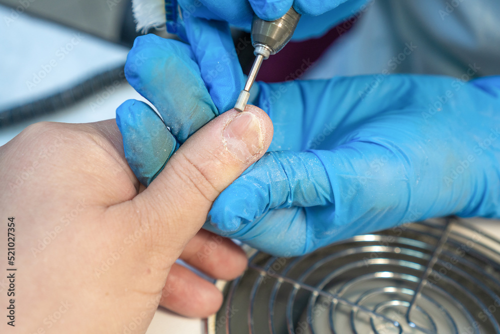 Onychomycosis fungal infection of the nail. Cleaning and processing of ...