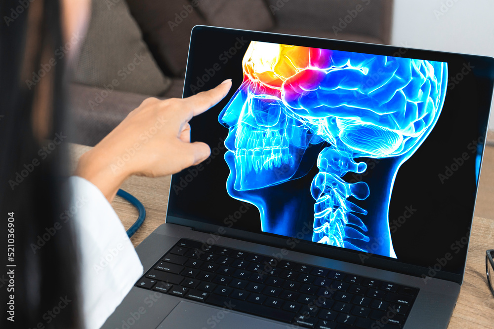 Doctor showing a x-ray of pain in the brain on a laptop. Migraine ...