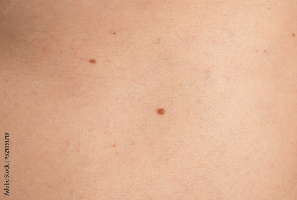 Checking benign moles. Close up detail of the bare skin on a man back ...