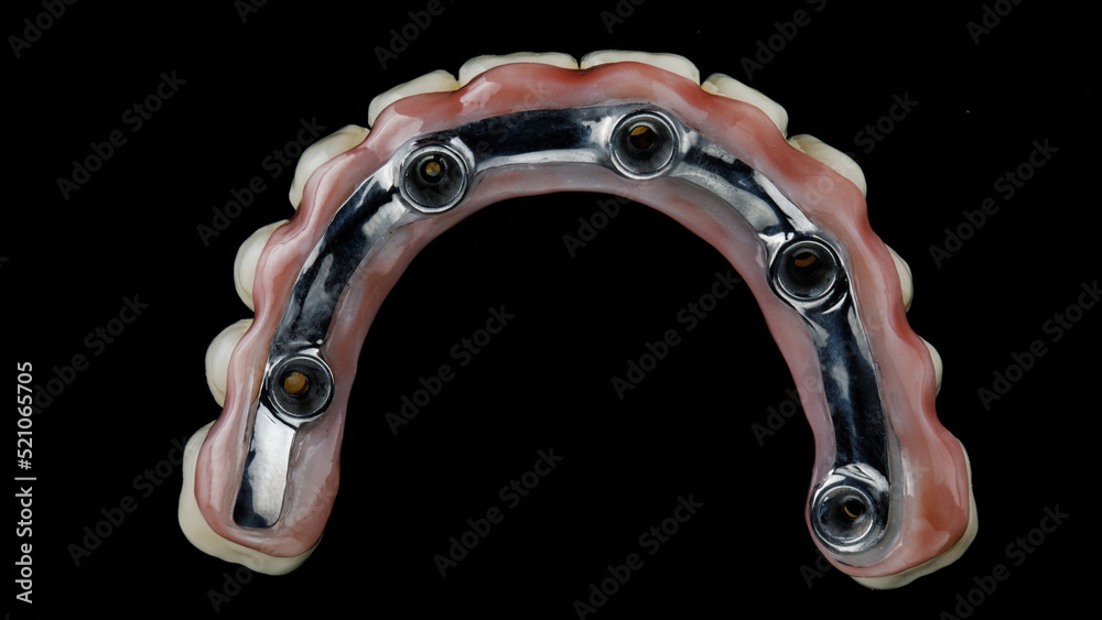 titanium bar in the prosthesis of the upper jaw, top view on a black ...