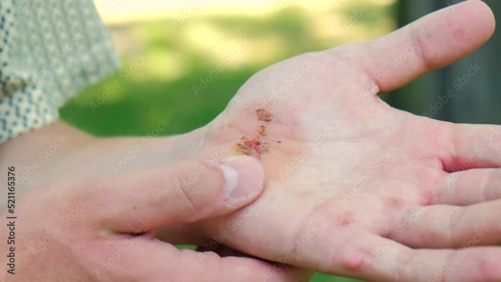 Close up man standing outside city park touch hurt hand, suffering from ...