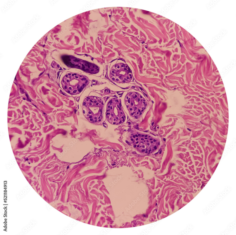 Abduminal wall skin tissue histology. Ashy dermatosis, show basal ...