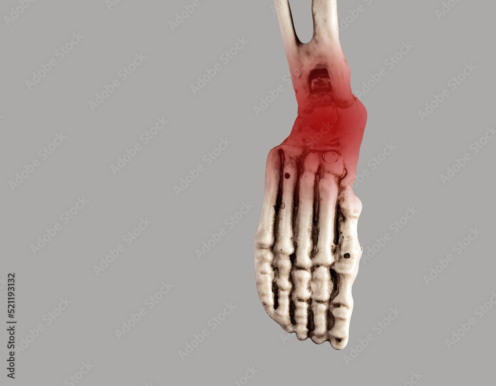 Human skeleton foot with red point at heel and ankle. Injury, plantar ...