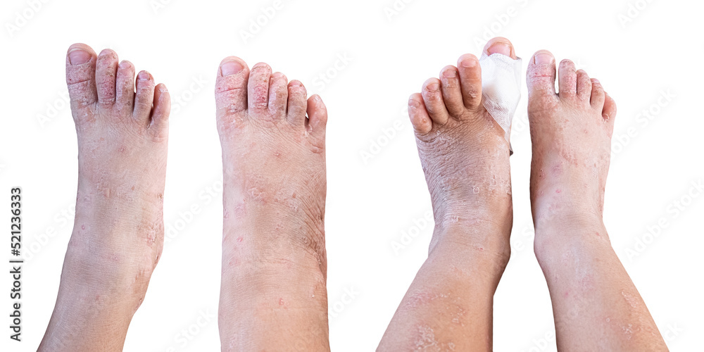 Eczema Irritation caused by allergic skin lesions on the feet ...