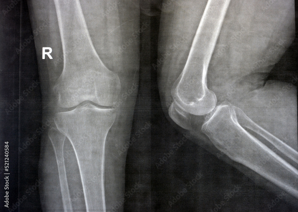 Plain X ray of the right knee shows apparent joint osteoarthritis ...