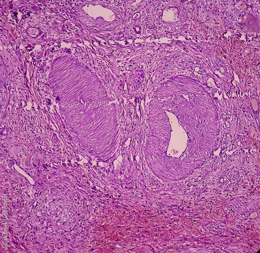 Dermoid Cyst Mature Cystic Teratoma Show Skin Adnexal Structure