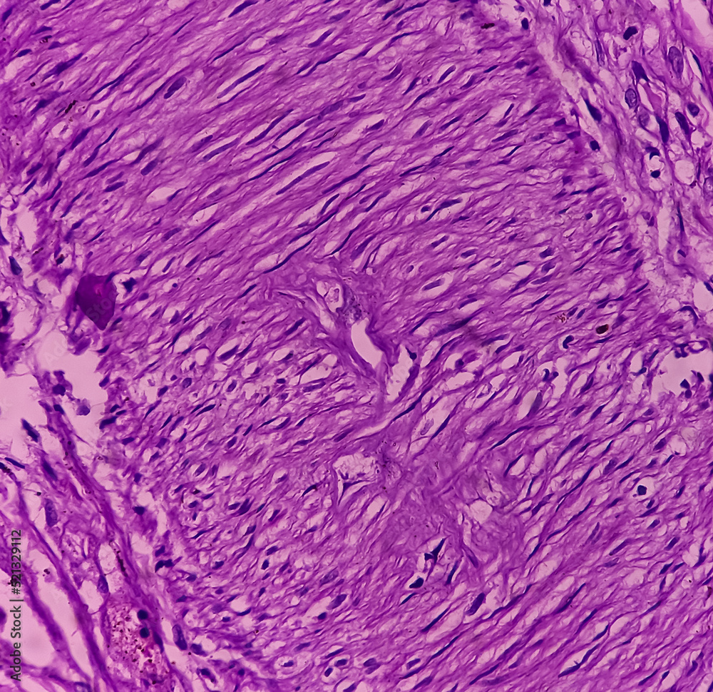 Dermoid Cyst Mature Cystic Teratoma Show Skin Adnexal Structure