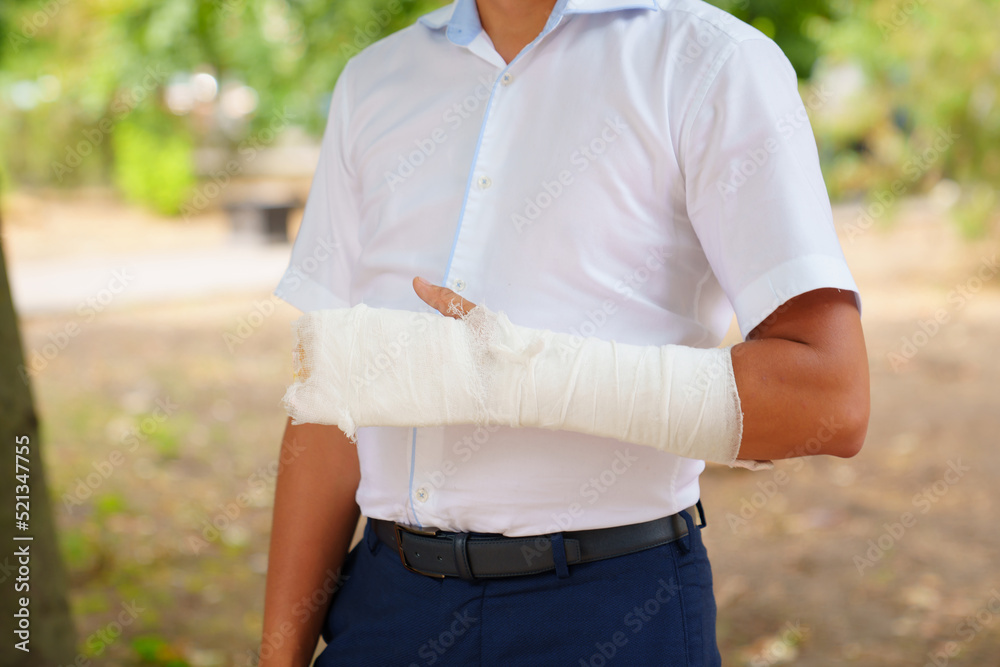 a man with a broken arm in a cast. treatment of limb fractures. Stock ...