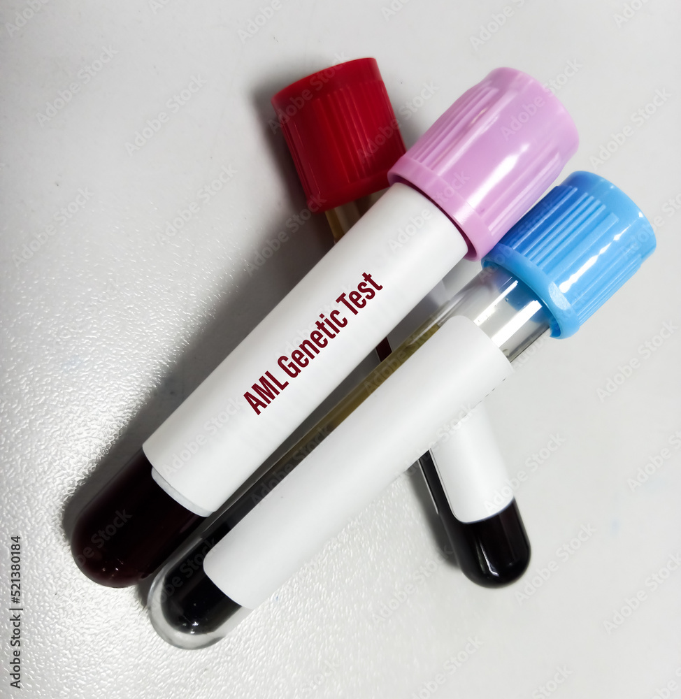 Blood sample for AML(Acute myeloid leukemia) genetic testing. Stock ...