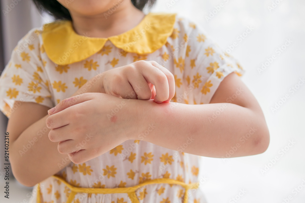 Little girl has skin rash allergy itching and scratching on her arm ...