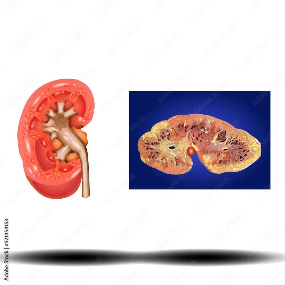 Kidney - internal organ, Kidney stones. Renal calculi, nephrolithiasis ...