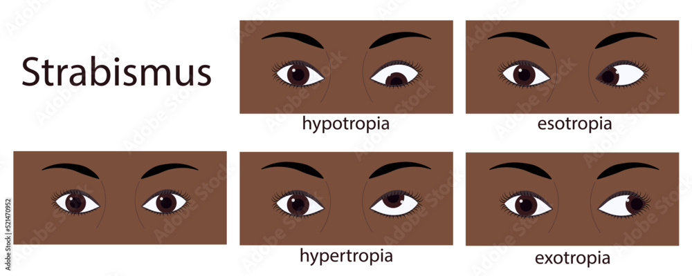 Strabismus flat style infographic set of stages: normal and disorders ...