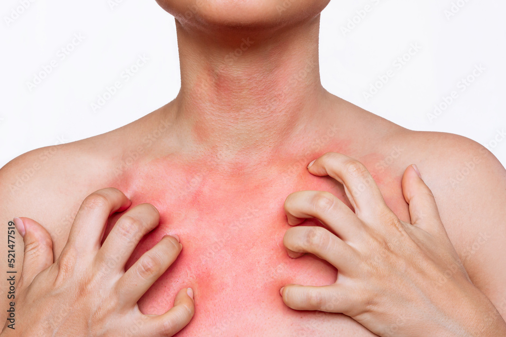 Cropped shot of a young caucasian woman with a red allergic rash on her ...