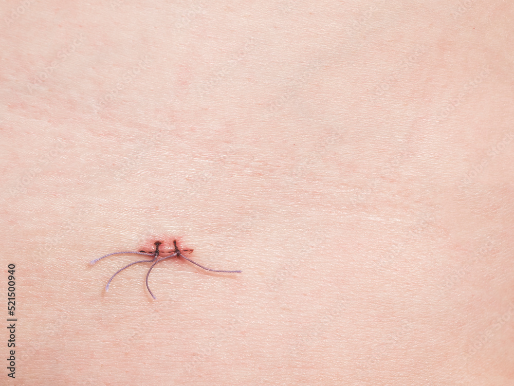 Non-absorbable suture on the skin, copy space. Little and careful ...