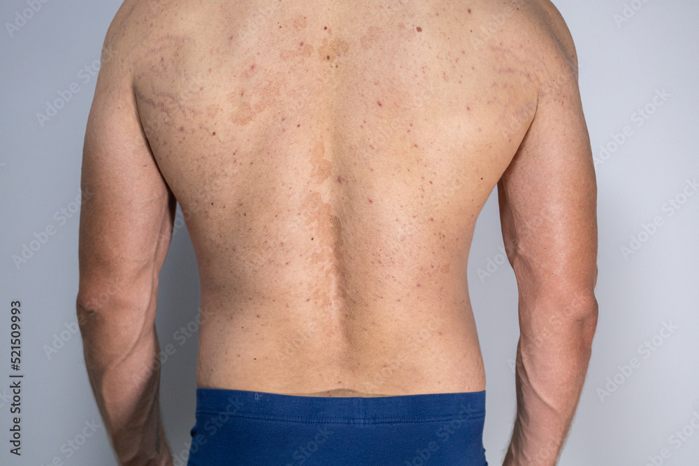 tinea versicolor on the back. pityriasis versicolor problem with skin ...