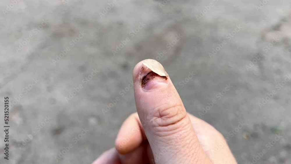 Damage to the nail plate, nail fungus. The nail plate comes off the ...