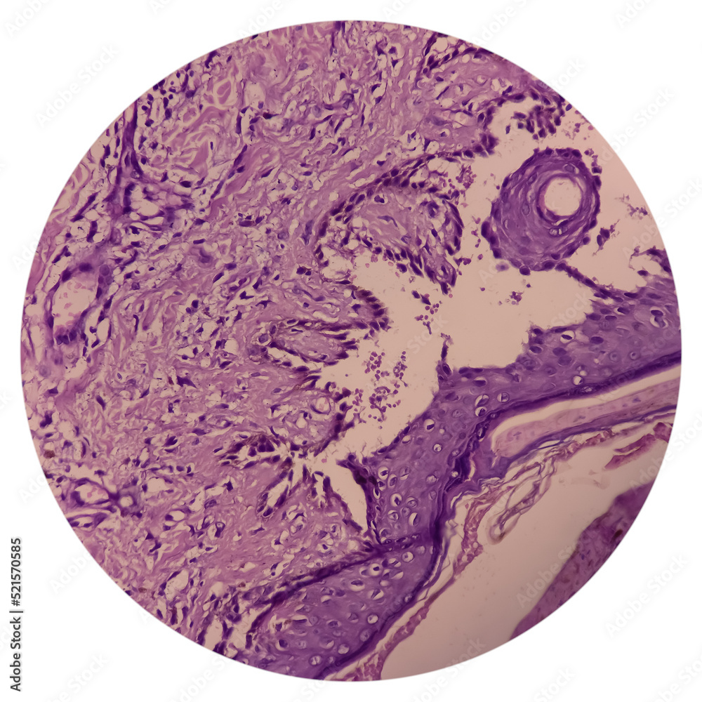 Microscopic image of back skin tissue, Pemphigus vulgaris, smear show ...