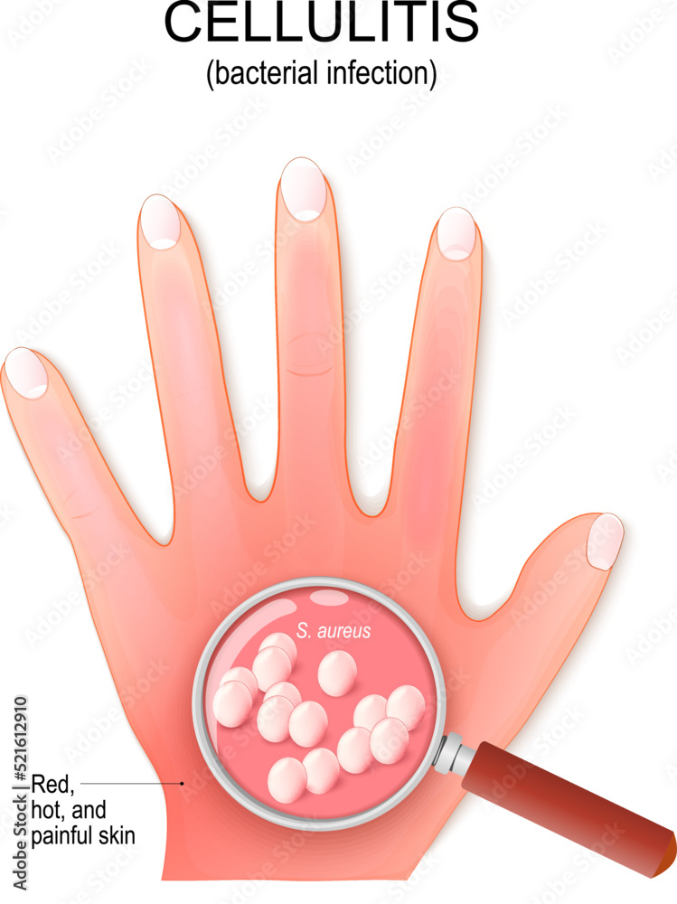 Cellulitis. Humans hand with bacterial infection. Stock Vector | Adobe ...
