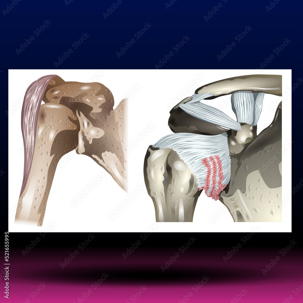 Frozen Shoulder - Fla source file available - Frozen shoulder occurs ...