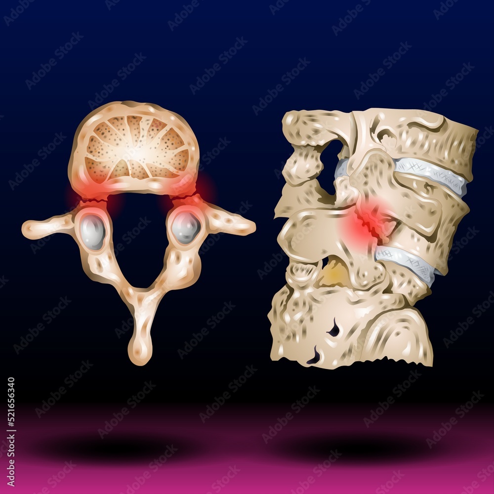 Spondylolisthesis (Stress Fractures) - Fla source file available ...