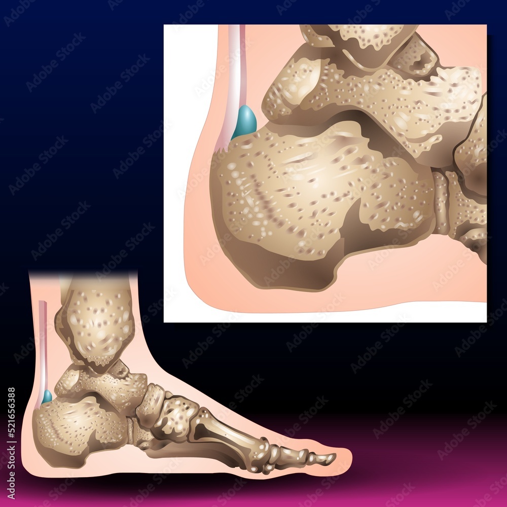 Toe Bone - Fla source file available - Fractures of the toes and ...