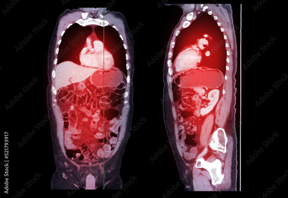 CT SCAN of Chest and Abdomen Coronal and sagittal view. Stock Photo ...